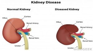 Types of Kidney Disease - Care for Kidney